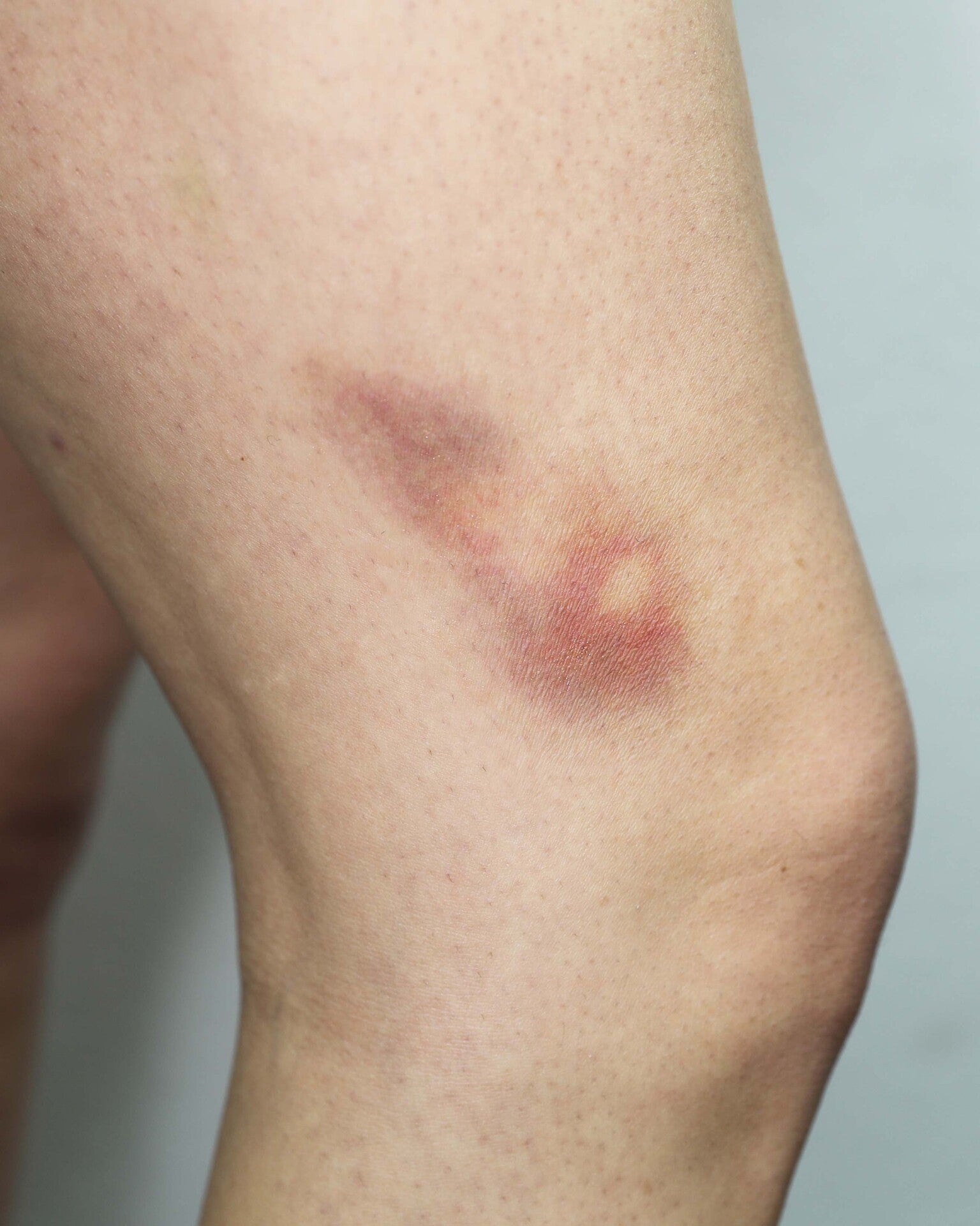 Hematomas 2B - Bruises 2B – Kitchen Makeup
