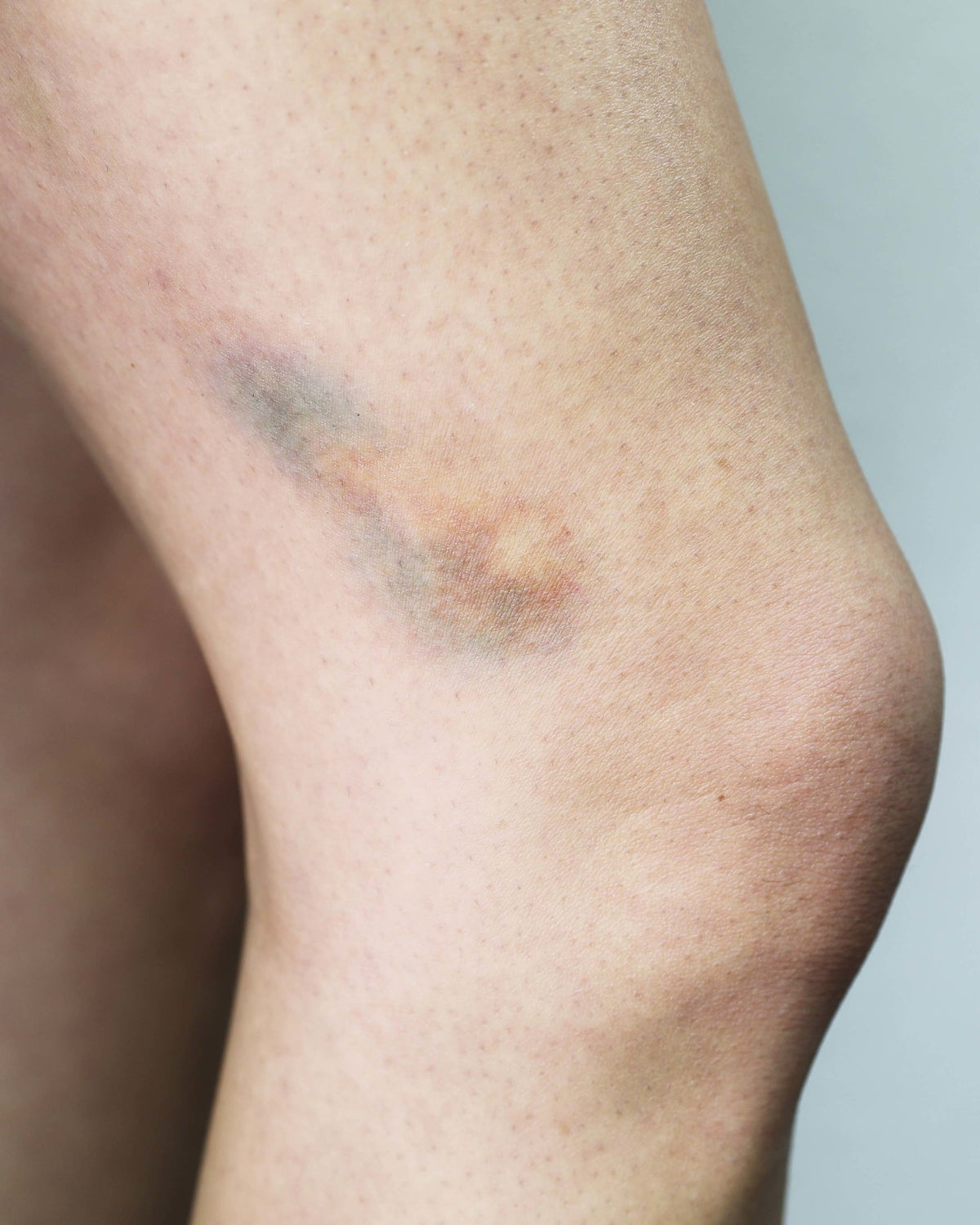 Hematomas 2C - Bruises 2C – Kitchen Makeup